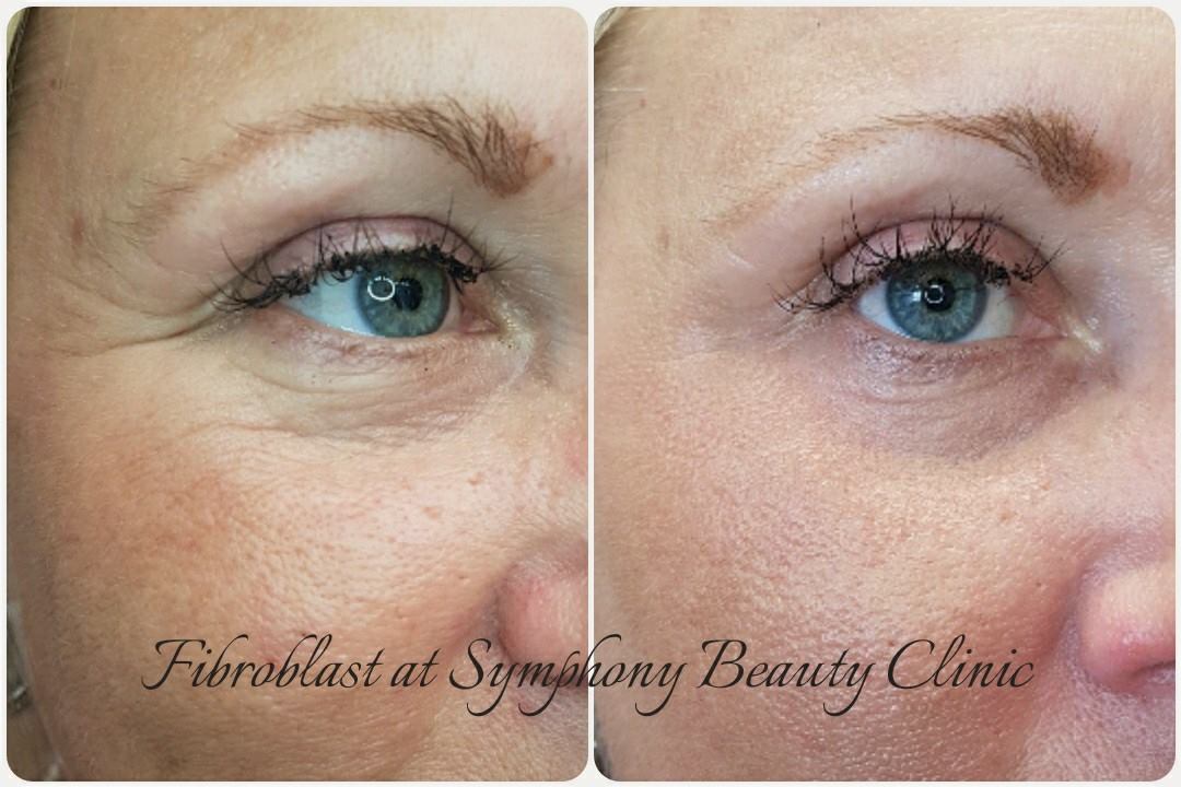 Fibroblast lower eyelid crease removal - BeauLine Aesthetics